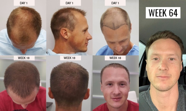 Fue Hair Transplant In Tijuana Mexico Medicalmex